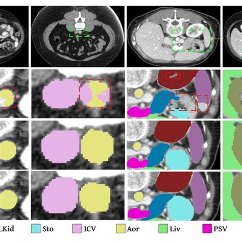Pdf Unetr Delving Into Efficient And Accurate 3d Medical Image