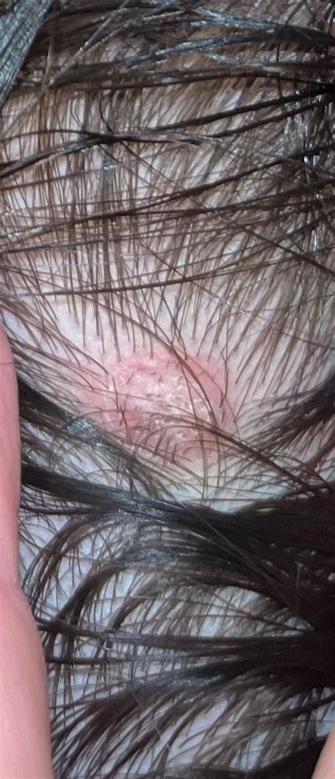 Wart On Scalp Or Something Else R Dermatologyquestions