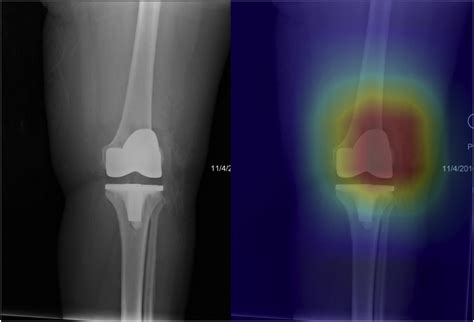 Automated Detection And Classification Of Knee Arthroplasty Using Deep Learning The Knee