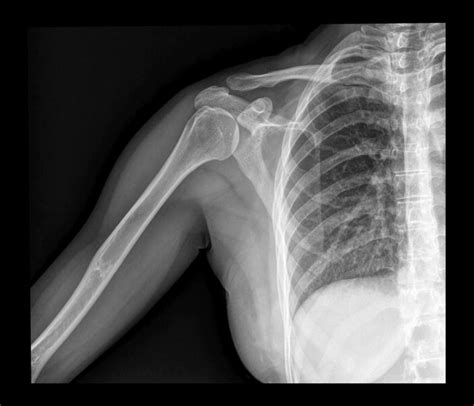 Normal Clavicle Xray The Clavicle Normal And Abnormal