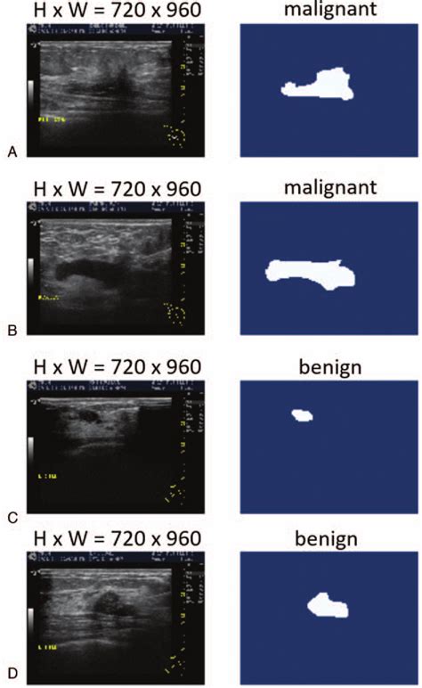 Example Of Tumor Contour A B An Original Image Of Malignant Tumor