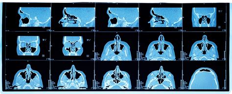 Deviated Septum How To Fix It Texas Sinus Snoring Houston