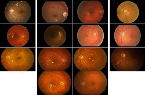 Od Detection In Exudate Images From Databases I E Ophtha Adcis 1st Download Scientific