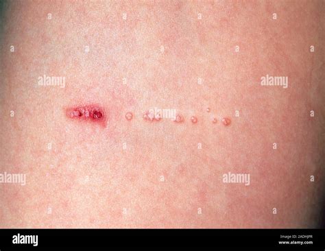 Molluscum Contagiosum Virus Molluscum Contagiosum Dellwarzen Quhgae