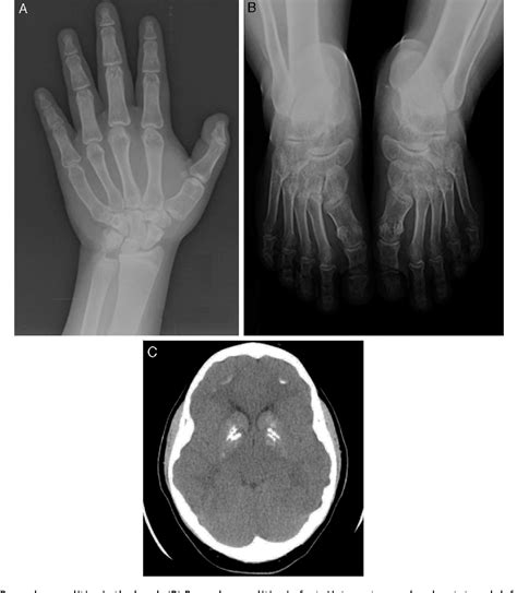 Figure 2 From Clinical And Radiological Findings In A Case Of Pseudohypoparathyroidism Type 1a