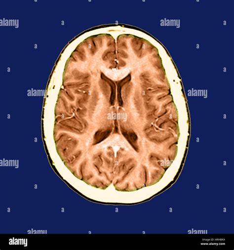 Mri Cross Sectional Anatomy Brain Brain Sectional Anatomy For