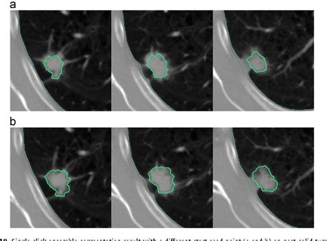 Figure 10 From Automated Delineation Of Lung Tumors From Ct Images Using A Single Click Ensemble