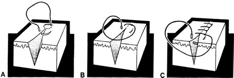 Figure The Locked Running Suture Surgical Methods