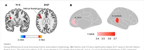 Figure 1 From Identifying The Neural Marker Of Chronic Sciatica Using Multimodal Neuroimaging