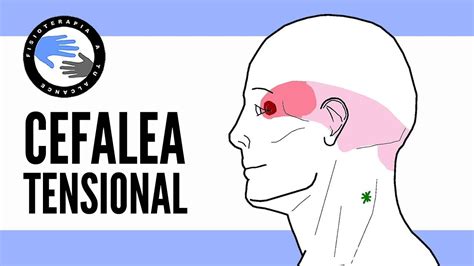 Cefalea Tensional Que Es Y Por Que Se Produce El Dolor De Cabeza Youtube