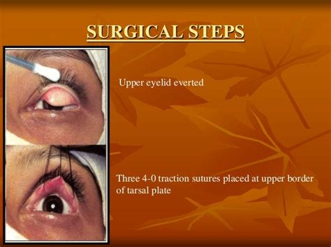 Ptosis Surgery