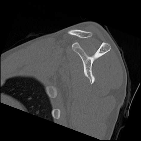 Normal Ct Shoulder Radiopaedia 60106 67676 Sagittal Bone Window Nc Commons