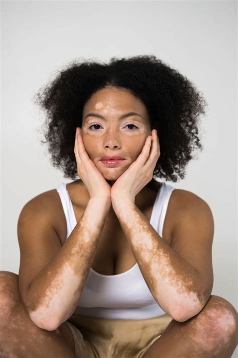 What Is Hypopigmentation And How Do You Treat It Allthingsbeauty