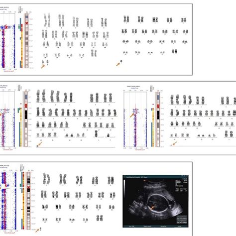 Snp Array And Karyotype Results Of Small Supernumerary Marker