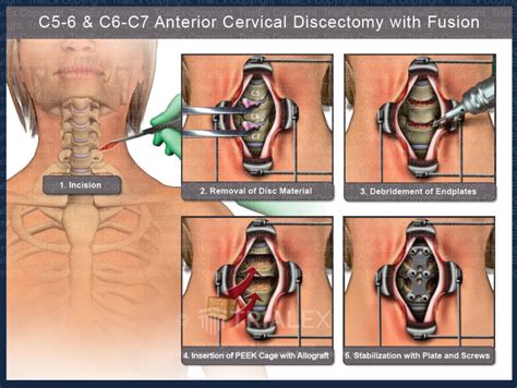 C5 6 And C6 7 Anterior Cervical Discectomy And Fusion
