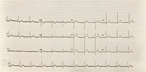 Understanding Vf And Pulseless Vt Symptoms Causes Treatment