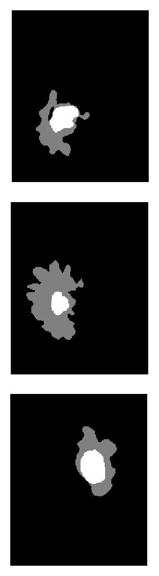 Segmentation Results Of The Active Tumor And Edema In The Real Clinical