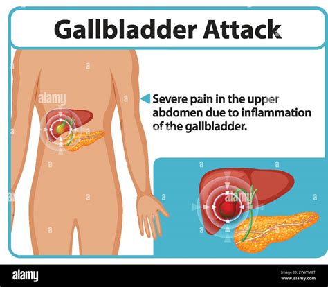 Illustration Of Gallbladder Pain And Inflammation Symptoms Stock Vector