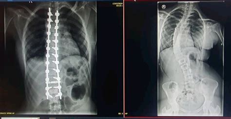 Correction Of Long Thoracic Curve With Shoulder Pelvic Imbalance And