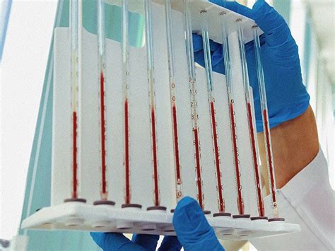 Multiple Myeloma Stages Explanation Outlook Coping And More