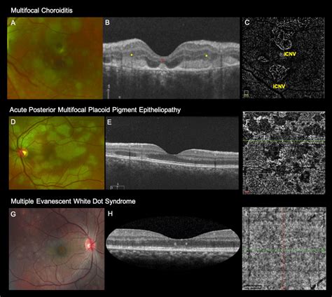 Octa Findings In White Dot Syndromes Are Reported In This Figure The Download Scientific