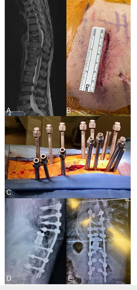 Figure 5 From Augmented Reality In Spinal Surgery Highlights From Augmented Reality Lectures At