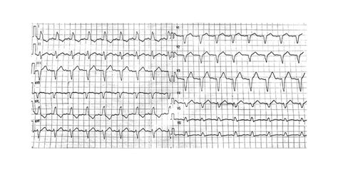 Intermittent Left Bundle Branch Block Lbbb As A Clinical Left Bundle