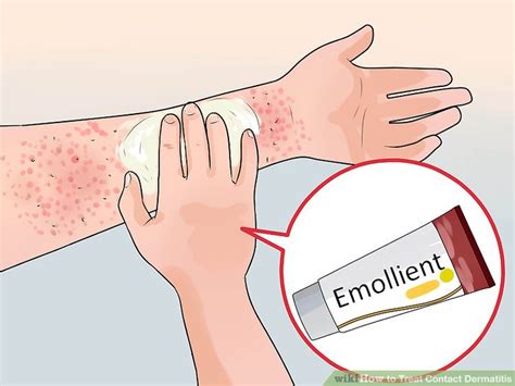 How To Treat Contact Dermatitis Steps With Pictures How To Treat Contact Dermatitis Steps With Pictures