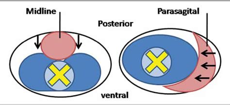 Ventral Epidural Space