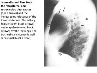 Learn Chest X Ray With Its Normal Positioning And Radio Anatomy Pptx