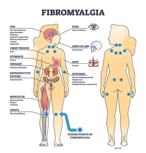 What Is Fibromyalgia — Morningside Acupuncture Nyc