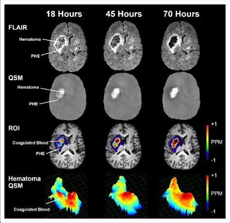An Illustration Of The Temporal Coagulation Within Hematoma Between Download Scientific Diagram