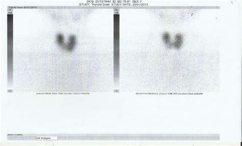 Study Of Thyroid Scan Of Patient 9 With ID 18 87 24 SEX M Download Scientific Diagram