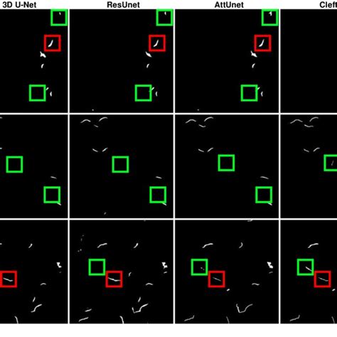 Qualitative Results For 3d U Net Resunet Attnunet And Cleftnet On Download Scientific