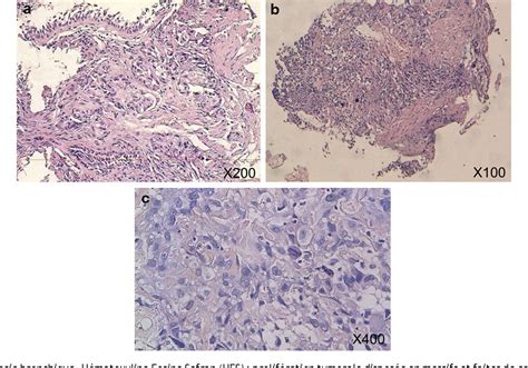 Acquired Keratoderma Semantic Scholar