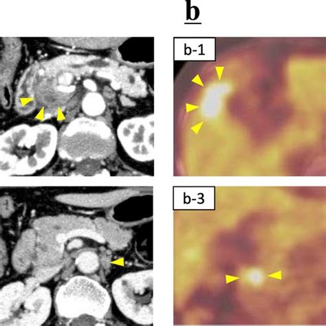 A Multidetector Row Computed Tomography Findings And The Lower Row