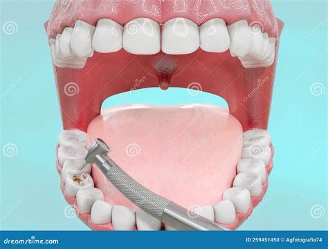 Human Tooth Caries Removal Process With Drill Machine Stock