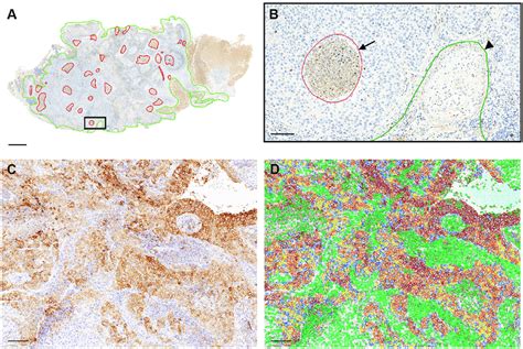 Example Of Computational Tissue Analysis CTA Of NSCLC Sections A Download Scientific