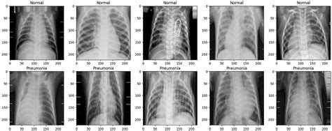 Building A Pneumonia Detection Model With Transfer Learning By Harikrishnan K Medium