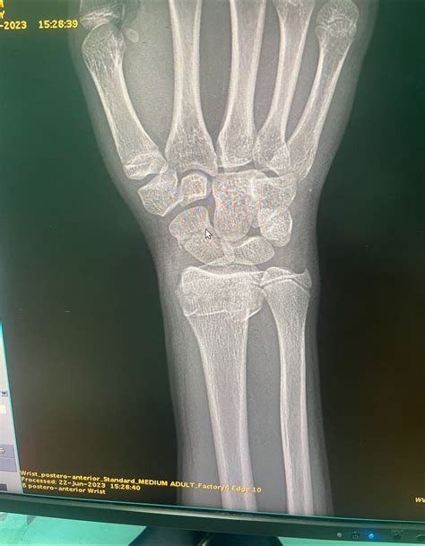 Musaab Bashir Mustafa On Linkedin Combined Distal Radius And Scaphoid Fracture