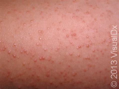 Itchy White Bumps On Skin