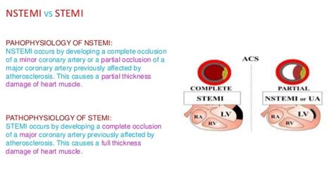 Acute Mi Nstemi
