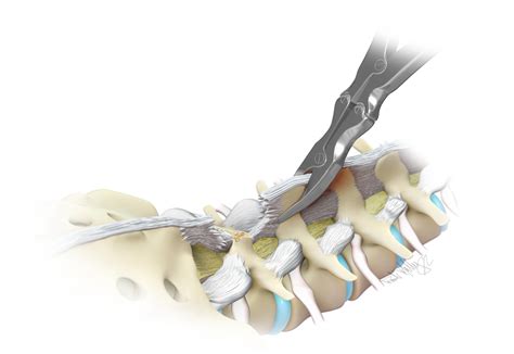 Lumbar Decompression Pkvisualization Surgery