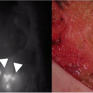 Clinical Case 2 Visualization Of The Sentinel Lymph Node In Download Scientific Diagram