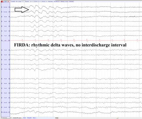 Firda Frontal Intermittent Rhythmic Delta Activity Eegpedia