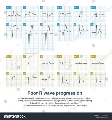 Poor R Wave Progression Can Be Stock Illustration Shutterstock