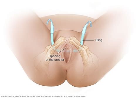 Bladder Prolapse After Bladder Sling