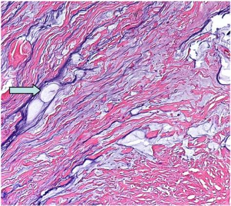 The Pathological Findings Of The Resected Appendix Extra Cellular Download Scientific Diagram