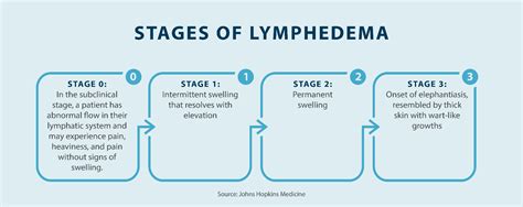 Understanding The Four Stages Of Lymphedema The Norton School Blog