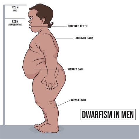 Dwarfism Pituitary Vs Achondroplasia Dwarfism Neuroendocrine Growth